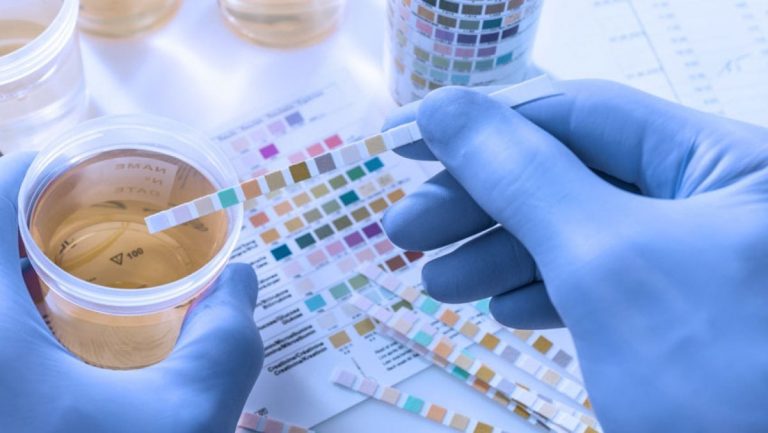 Urobilinogeno nelle urine: cause e valori normali - IreneMilito.it